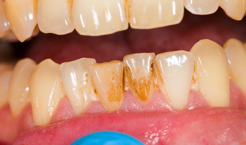What is Dental Plaque and Why Must it Be Treated? - MyOrthodontist